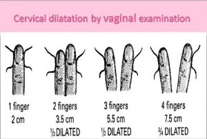 What Is 1 Cm Dilated And What To Do With It? - ShrewdMommy